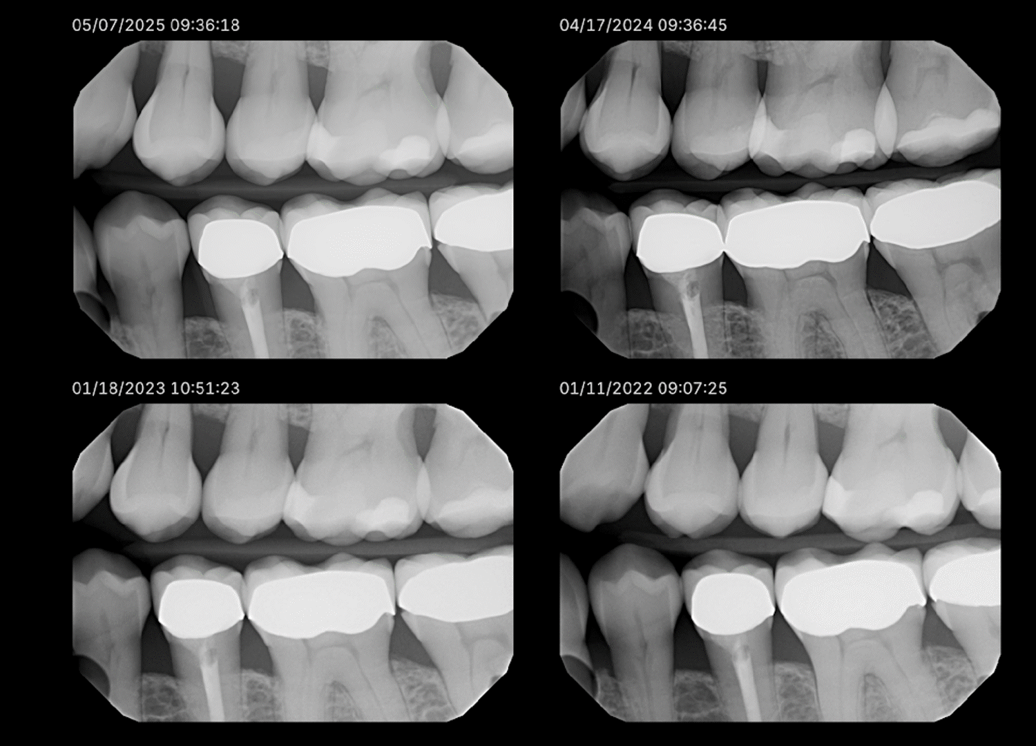 The Story Beneath the Surface: Using AI to See the Progression Even a ...