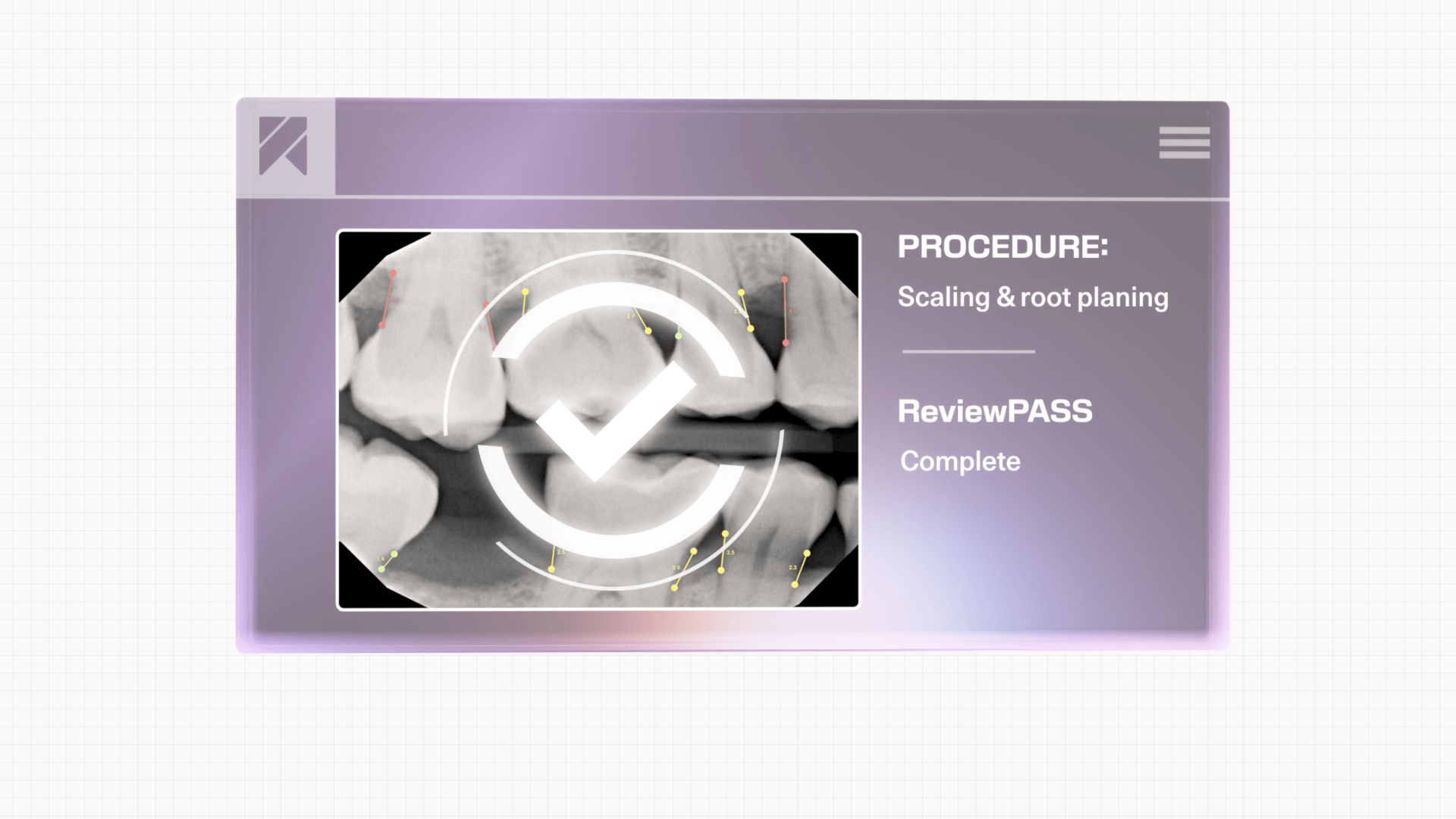 Overjet | Overjet Dental Glossary